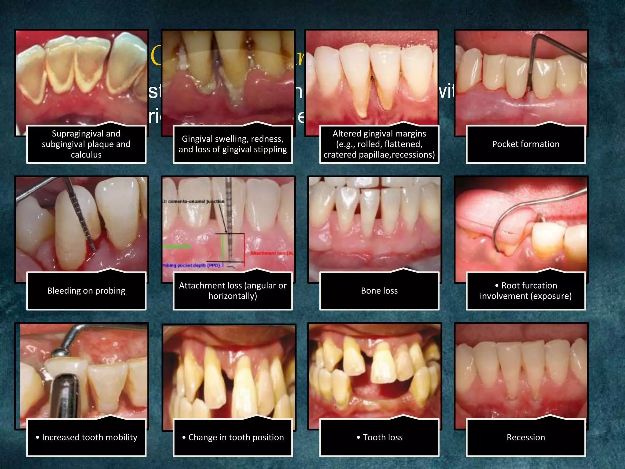 Chronic periodontitis | PPTX