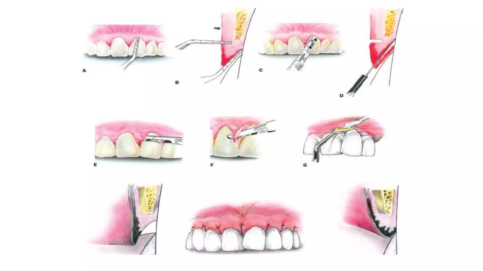 Gingival surgical techniques/Gingivectomy | PPTX