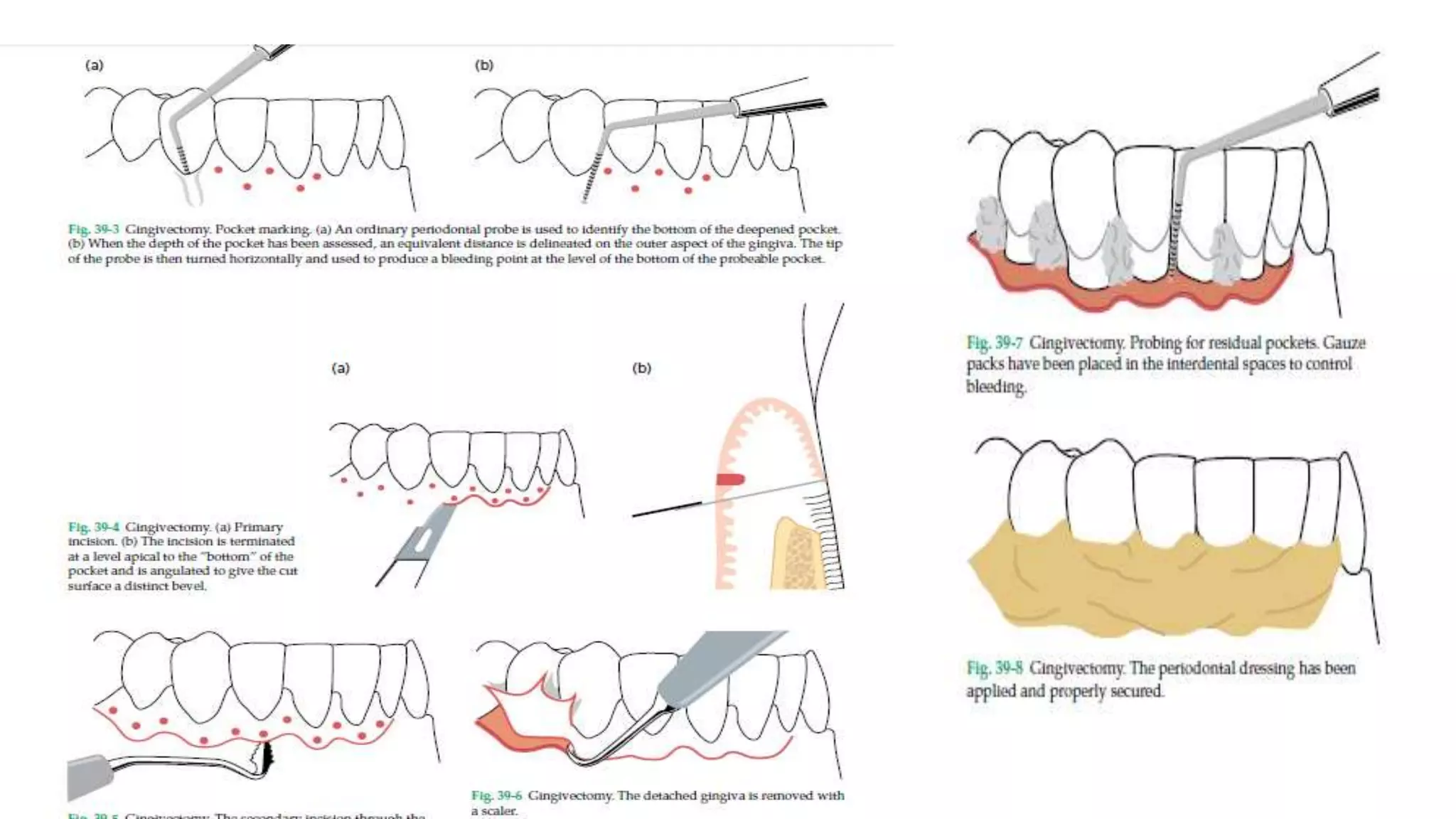 Gingival surgical techniques/Gingivectomy | PPTX