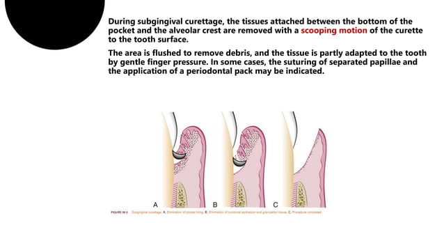 Gingival surgical techniques/Gingivectomy | PPTX | Oral care | Personal ...