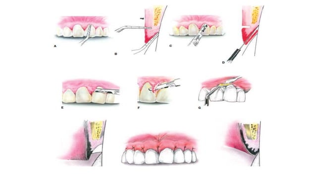 Gingival surgical techniques/Gingivectomy | PPTX | Oral care | Personal ...