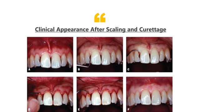 Gingival surgical techniques/Gingivectomy | PPTX | Oral care | Personal ...