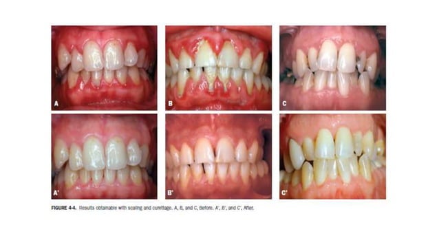 Gingival surgical techniques/Gingivectomy | PPTX | Oral care | Personal ...