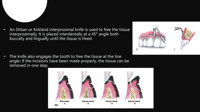 Gingival surgical techniques/Gingivectomy | PPTX | Oral care | Personal ...