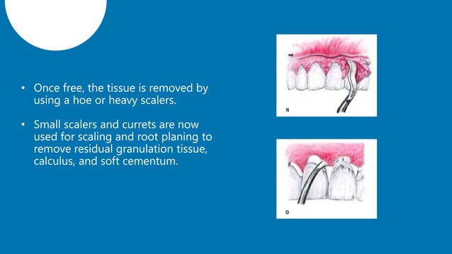 Gingival surgical techniques/Gingivectomy | PPTX | Oral care | Personal ...