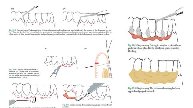 Gingival surgical techniques/Gingivectomy | PPTX | Oral care | Personal ...