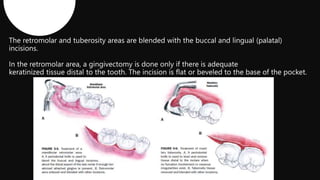 Gingival surgical techniques/Gingivectomy | PPTX