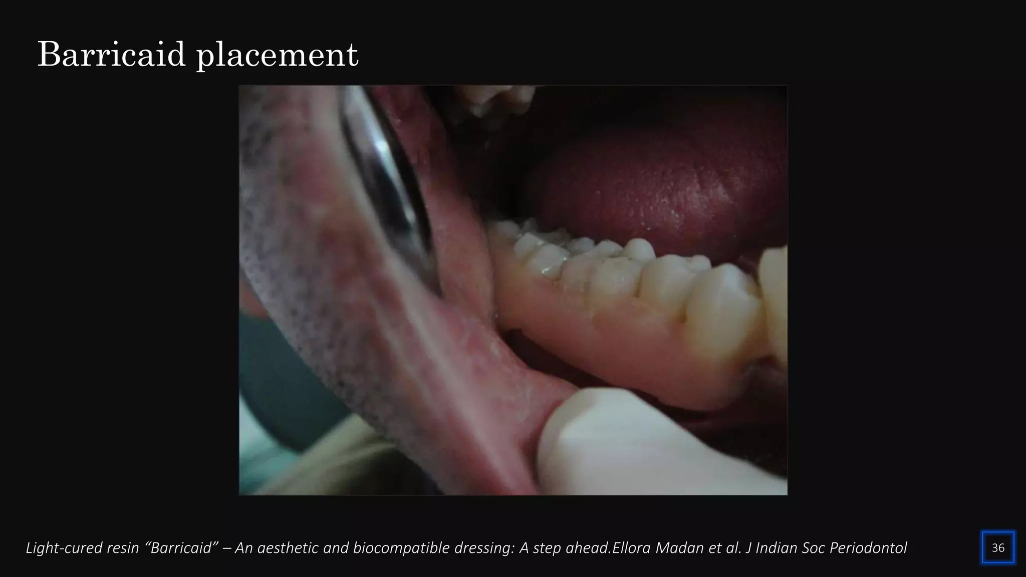 Periodontal dressing | PPTX