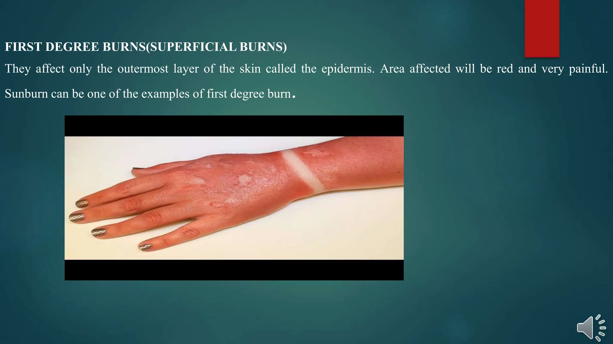 THATO LEBONA (BURNS AND SCALDS)PROJECT.pptx