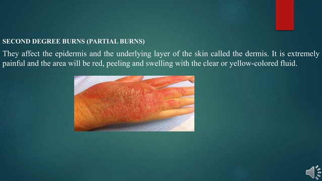 THATO LEBONA (BURNS AND SCALDS)PROJECT.pptx