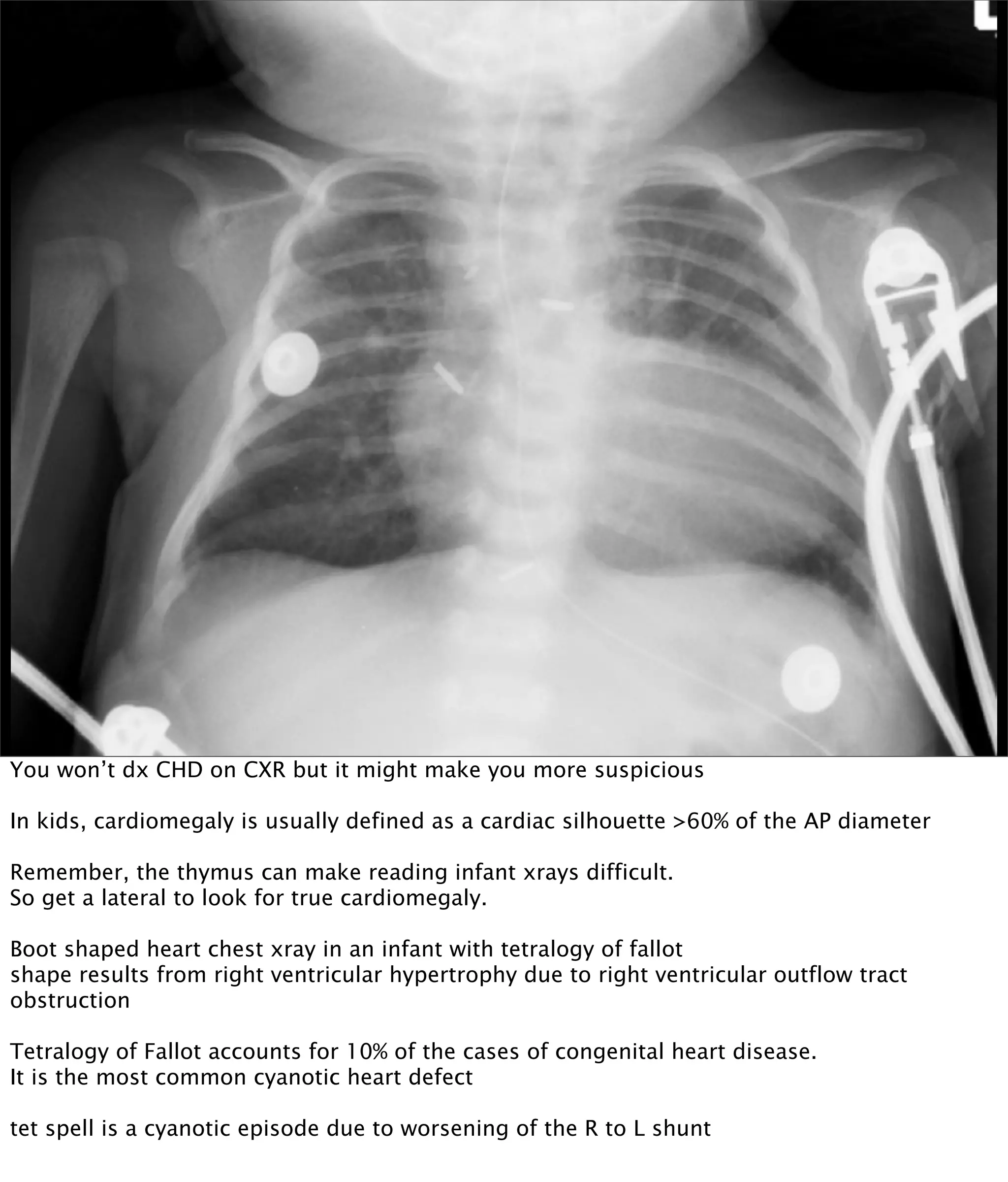 The Crashing Cardiac Baby | PDF