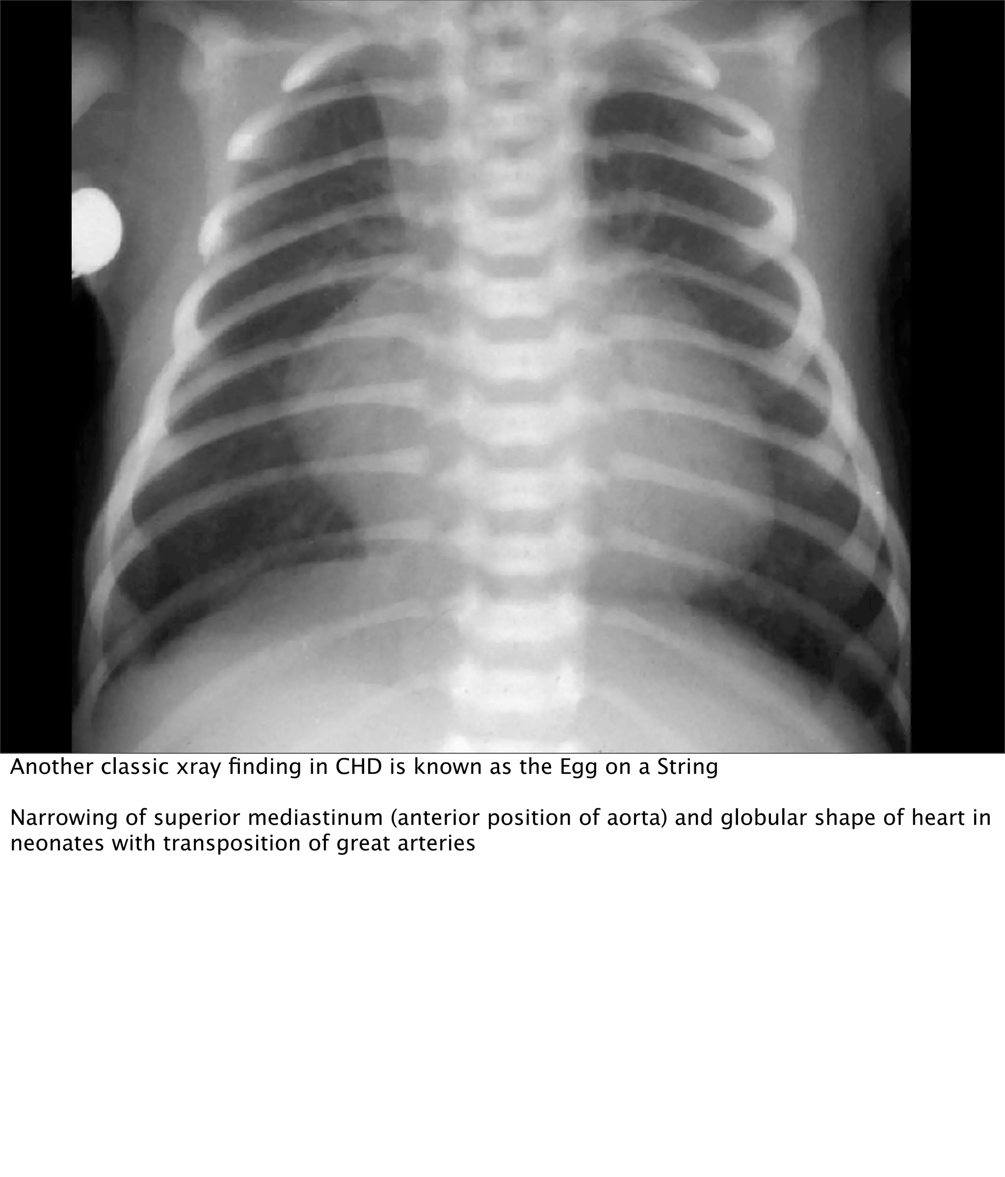 The Crashing Cardiac Baby | PDF | Heart and Cardiovascular Diseases ...