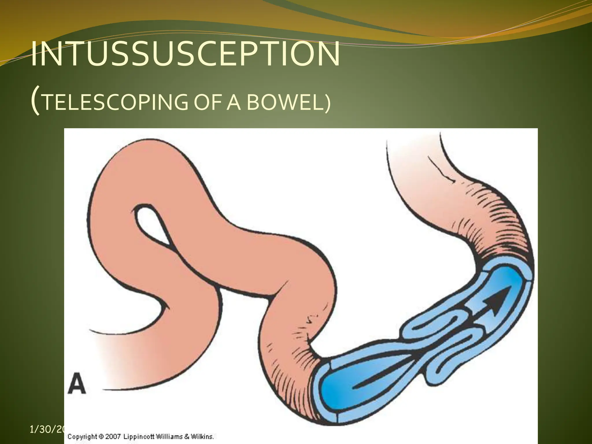 TheDigestivesystem2999999999999999999999 | PPTX | Digestive Disorders ...