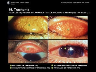 the eye in primary care | PPT