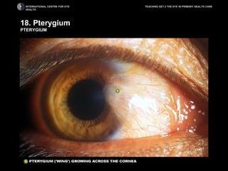 the eye in primary care | PPT