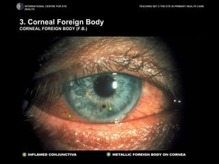 the eye in primary care | PPT