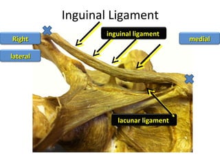 Lacunar Ligament Cadaver