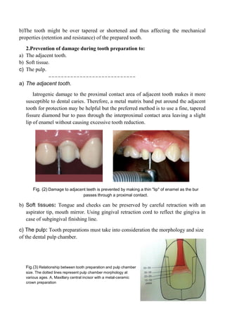 The-principles-of-tooth-preparation-may-be-divided-into-three-broad ...
