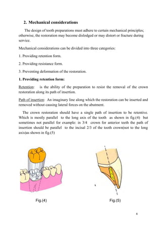 The-principles-of-tooth-preparation-may-be-divided-into-three-broad ...