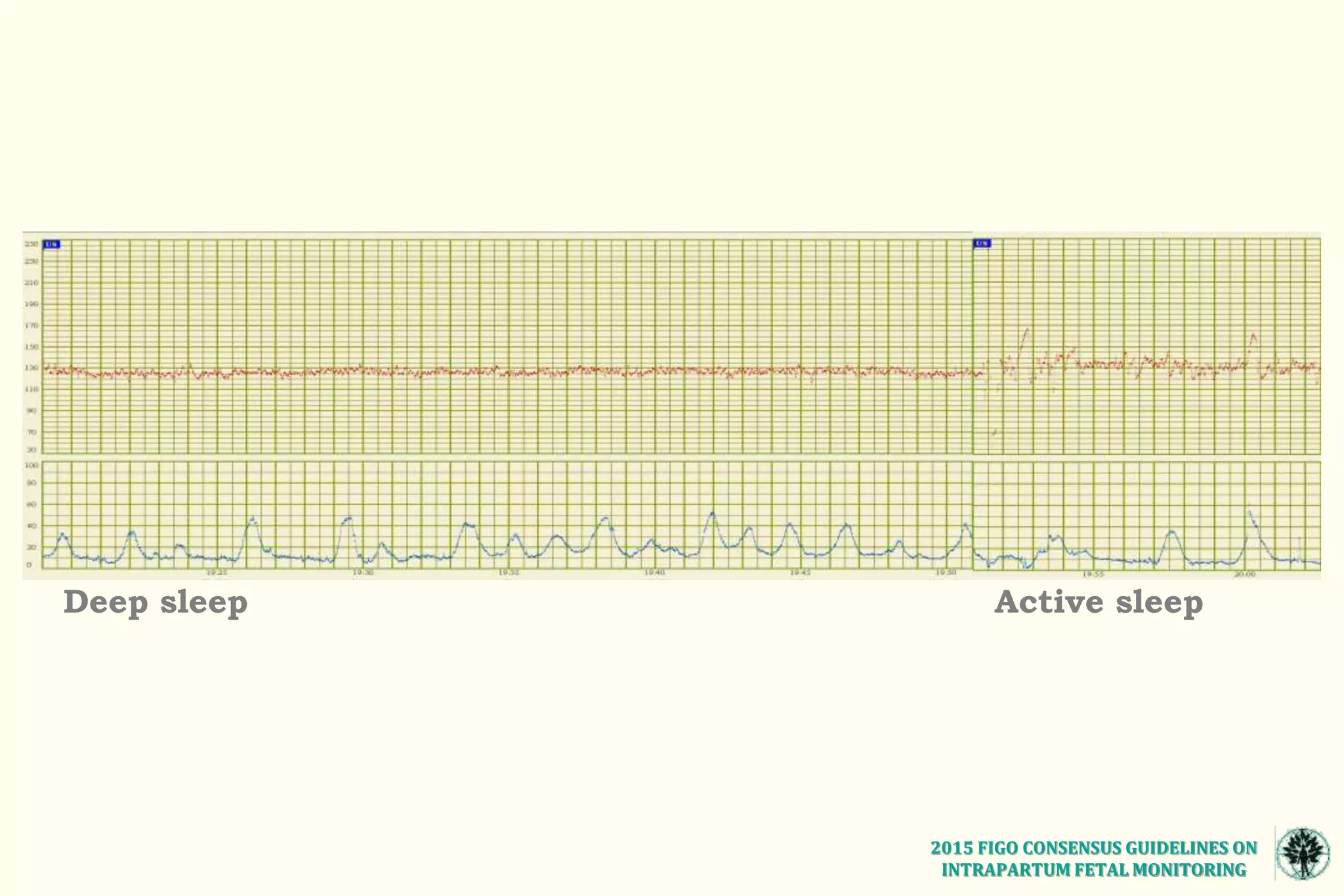 The 2015 FIGO consensus guidelines on intrapartum fetal monitoring ...