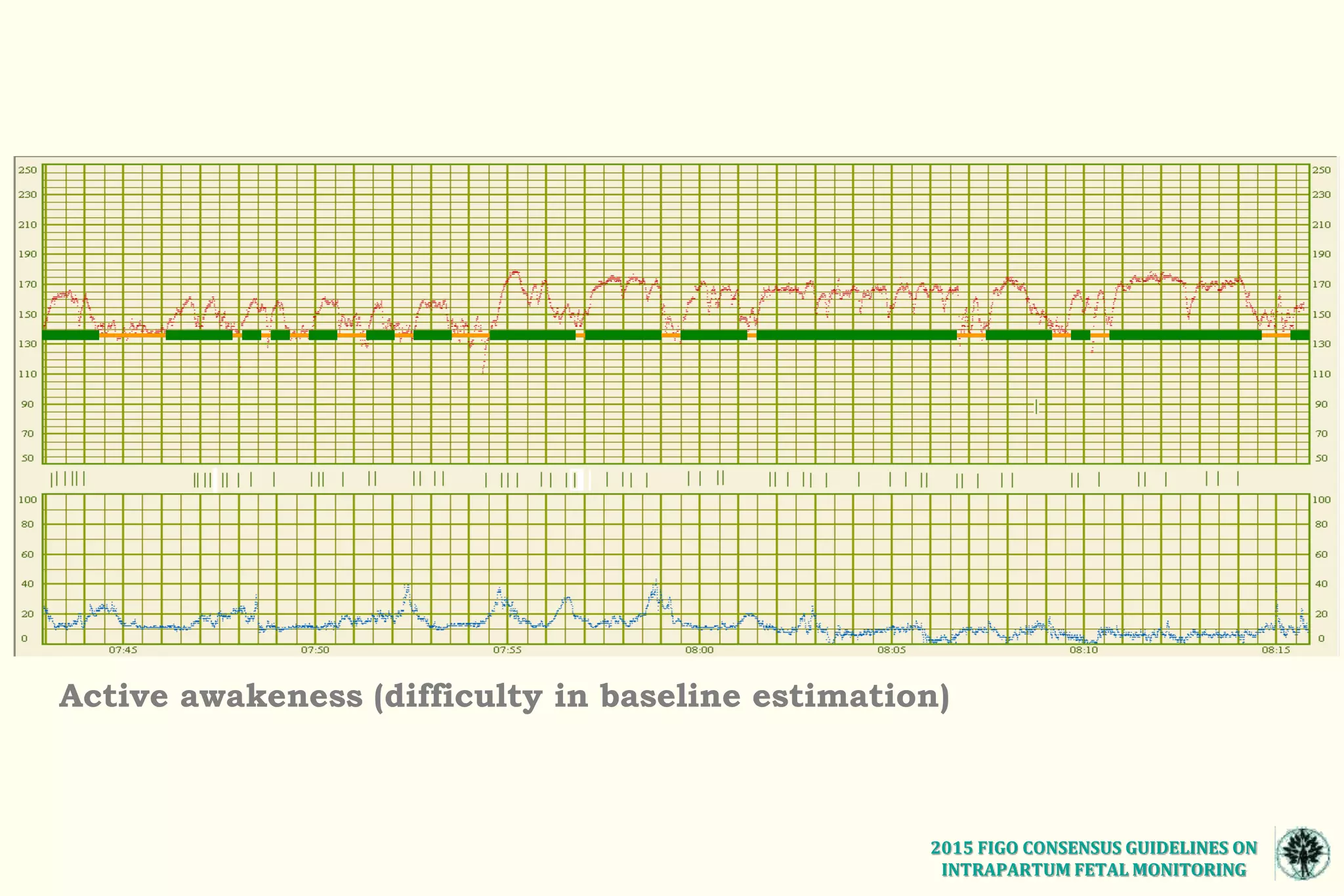 The 2015 FIGO consensus guidelines on intrapartum fetal monitoring ...