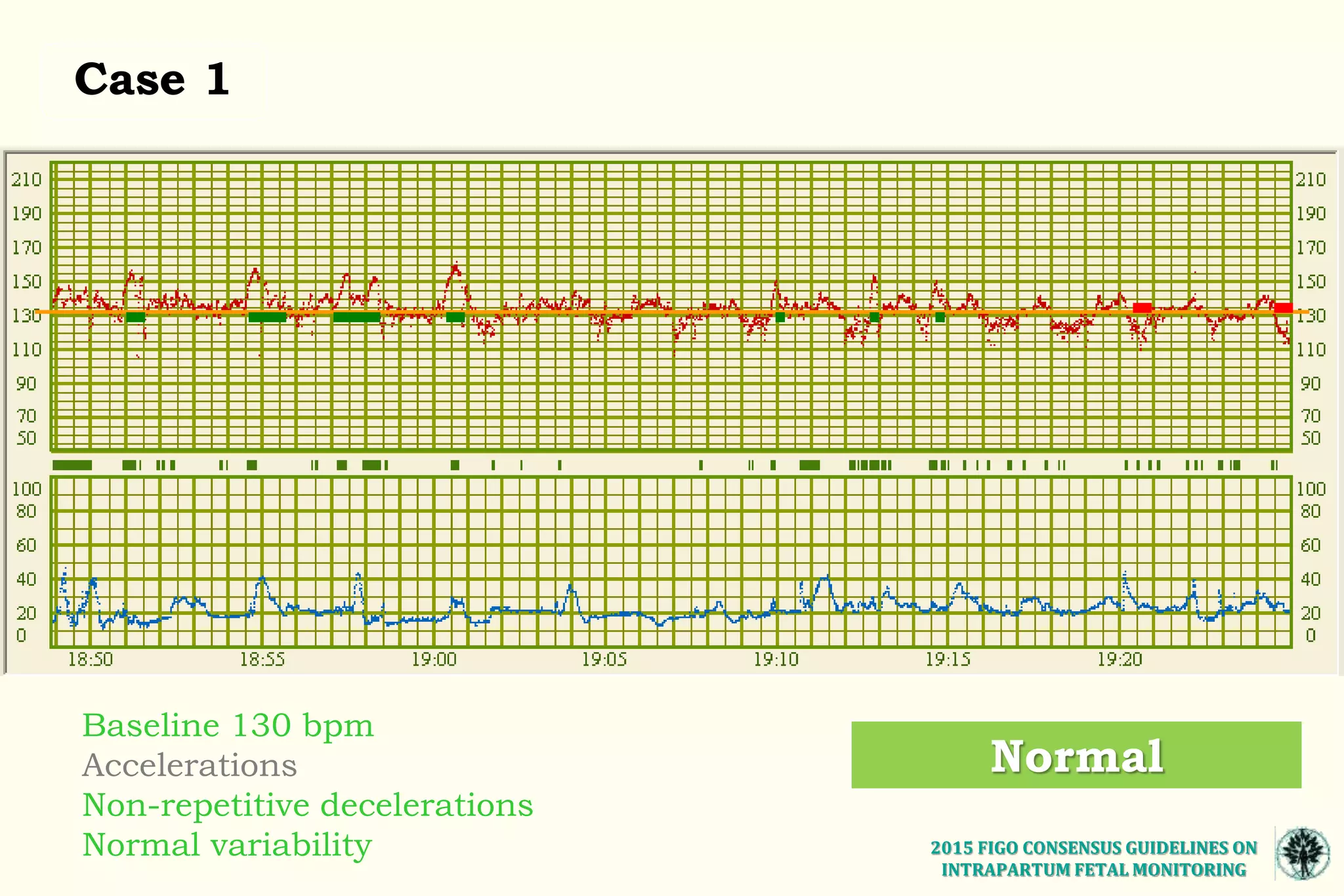 The 2015 FIGO consensus guidelines on intrapartum fetal monitoring ...