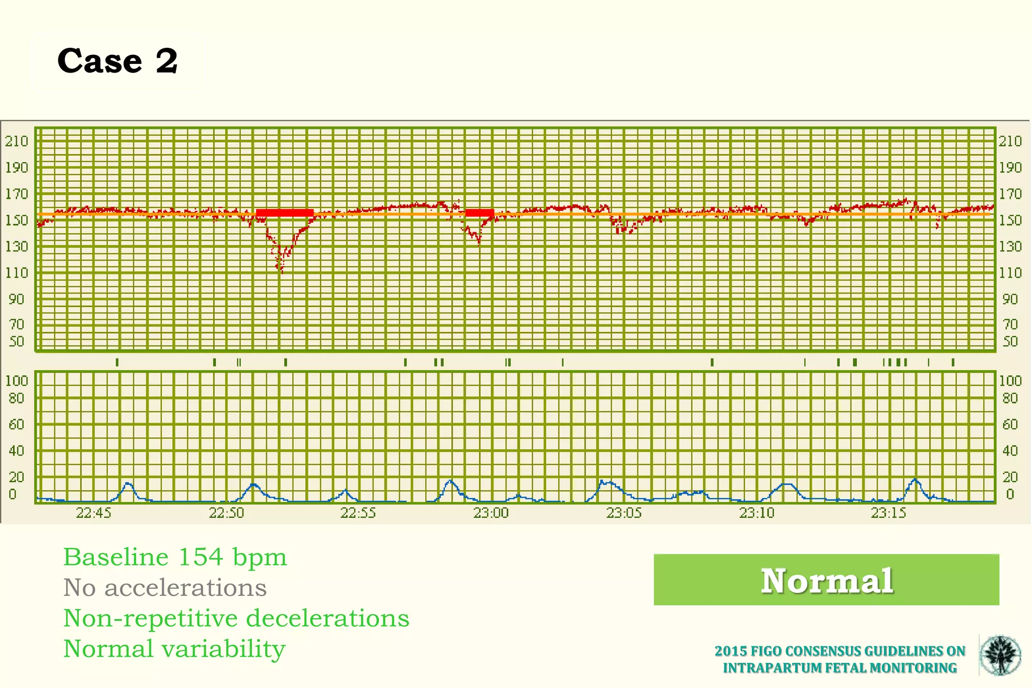 The 2015 FIGO consensus guidelines on intrapartum fetal monitoring ...