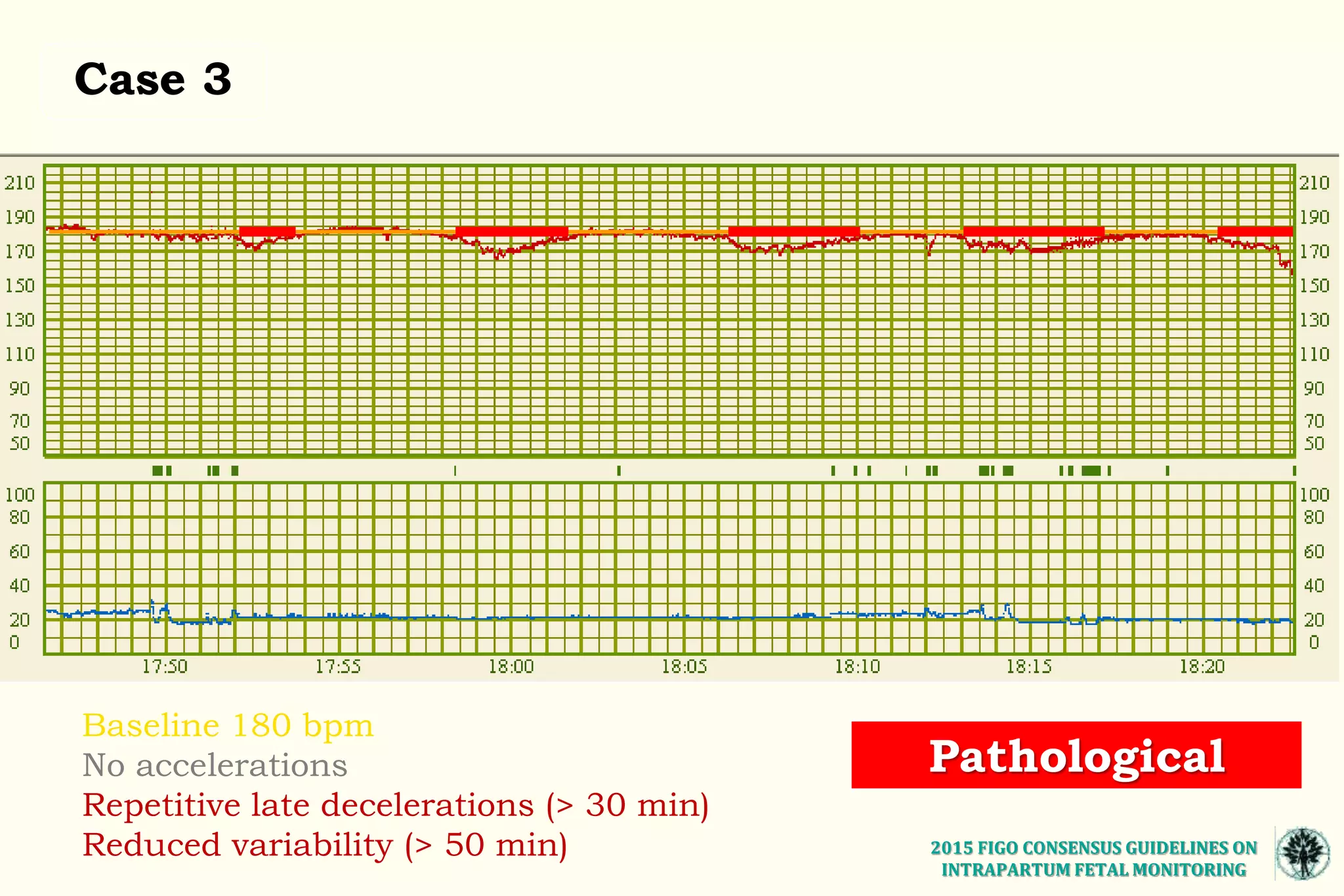 The 2015 FIGO consensus guidelines on intrapartum fetal monitoring ...