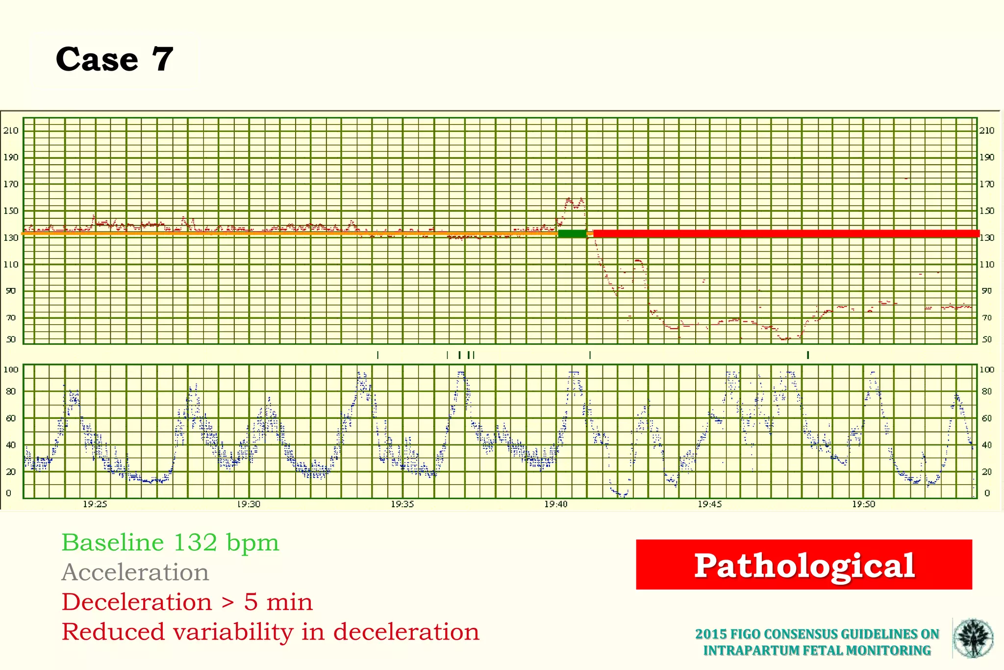 The 2015 FIGO consensus guidelines on intrapartum fetal monitoring ...