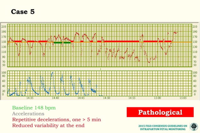 The 2015 FIGO consensus guidelines on intrapartum fetal monitoring ...