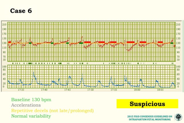 The 2015 FIGO consensus guidelines on intrapartum fetal monitoring ...