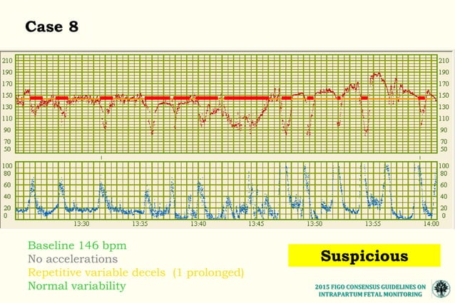 The 2015 FIGO consensus guidelines on intrapartum fetal monitoring ...
