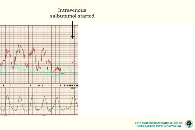 The 2015 FIGO consensus guidelines on intrapartum fetal monitoring ...
