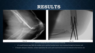 The pulseless pink hand after supracondylar fracture humerus | PPTX