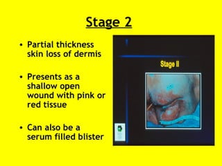 The 411 on wound care | PPT