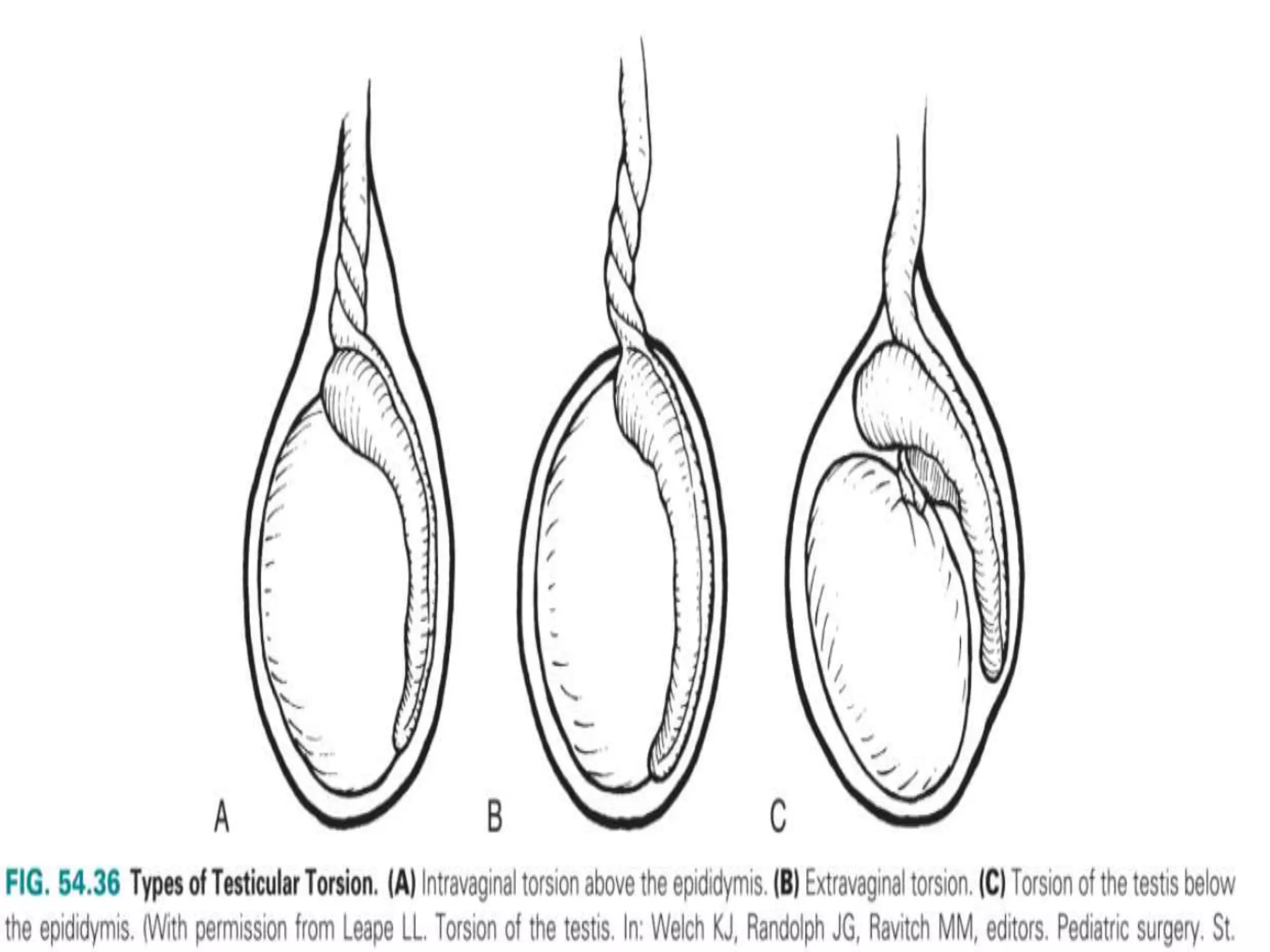 The Acute Scrotum.pptx