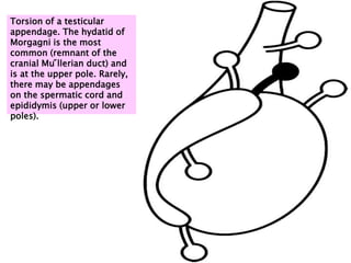 Testicular Appendage