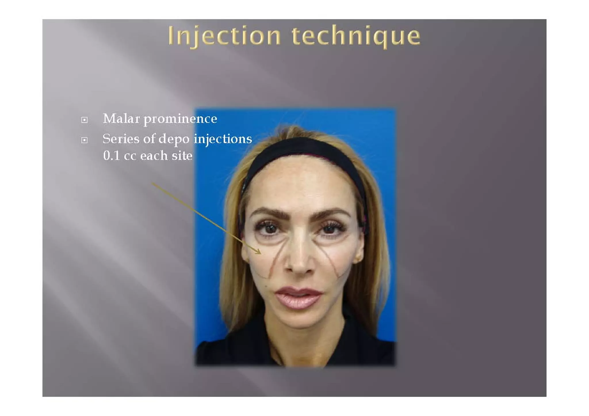 The Aesthetic Benefits of Malar Augmentation | PDF