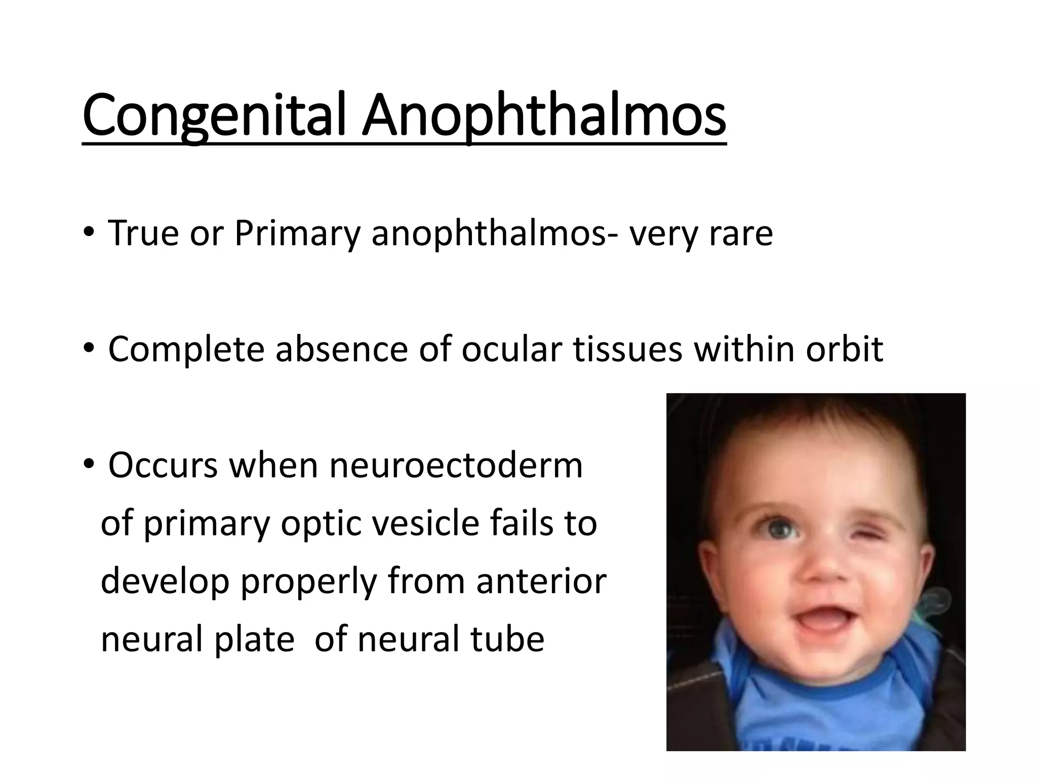 The Anophthalmic socket | PPTX