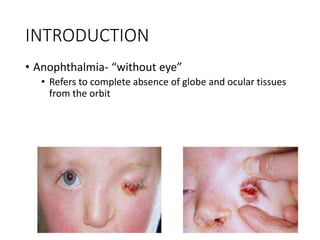 The Anophthalmic socket | PPTX