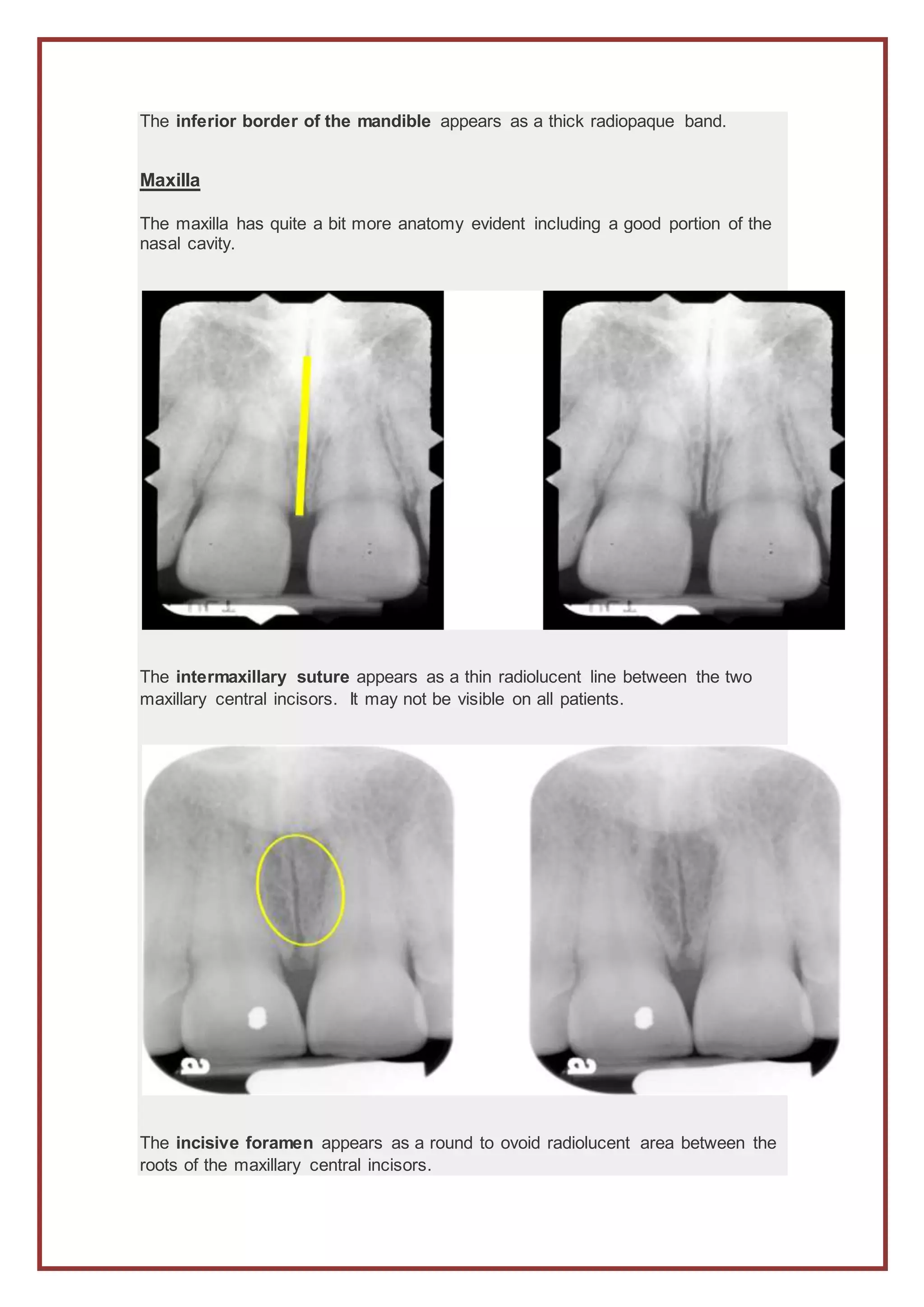 The anterior portion of intraoral radiographs | DOCX