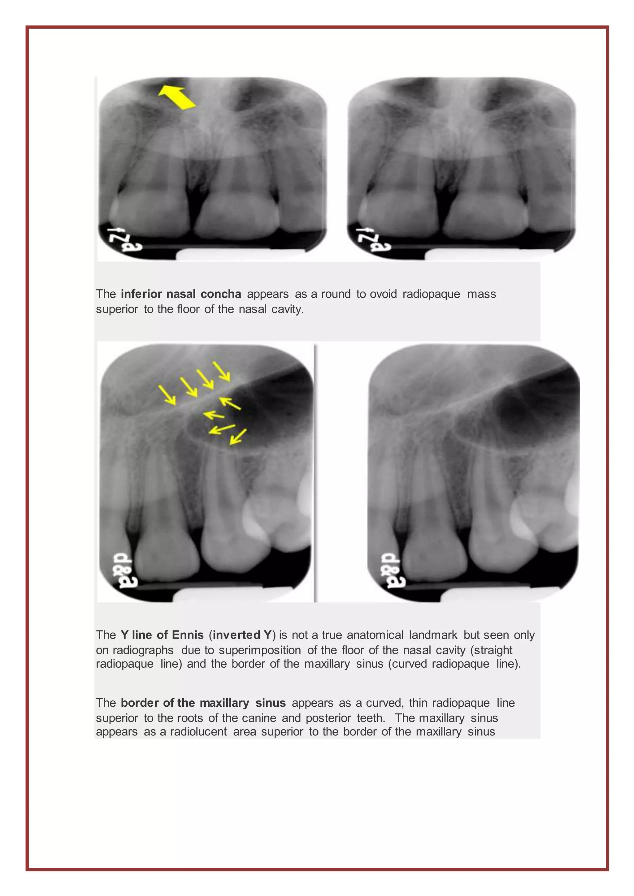 The anterior portion of intraoral radiographs | DOCX