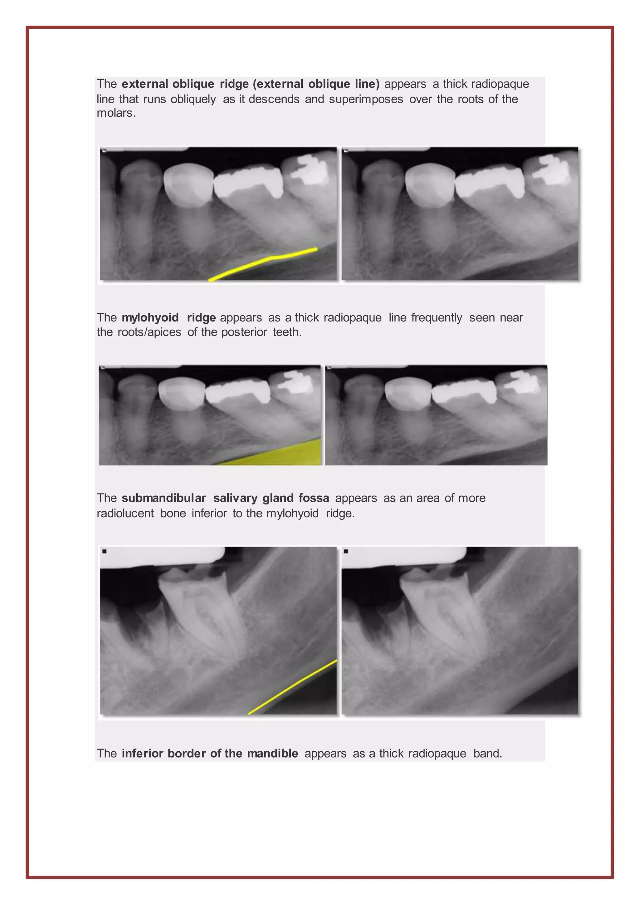 The anterior portion of intraoral radiographs | DOCX