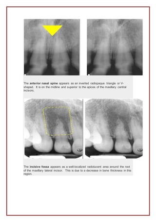 The anterior portion of intraoral radiographs | DOCX