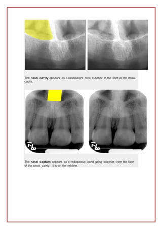 The anterior portion of intraoral radiographs | DOCX