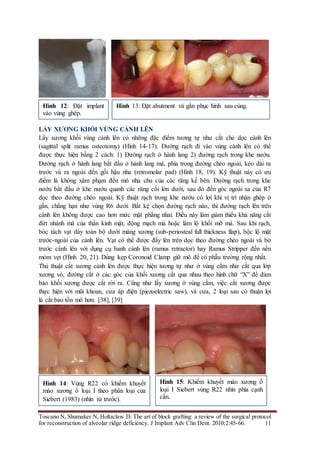 Ghép xương khối | DOCX