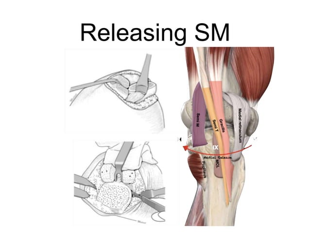 The art of medial release in varus knee during total knee replacement | PPT