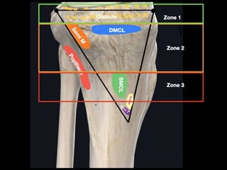 The art of medial release in varus knee during total knee replacement ...