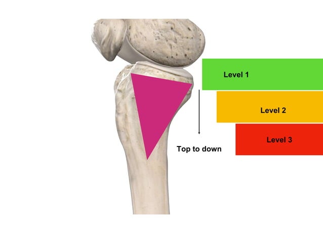 The art of medial release in varus knee during total knee replacement | PPT