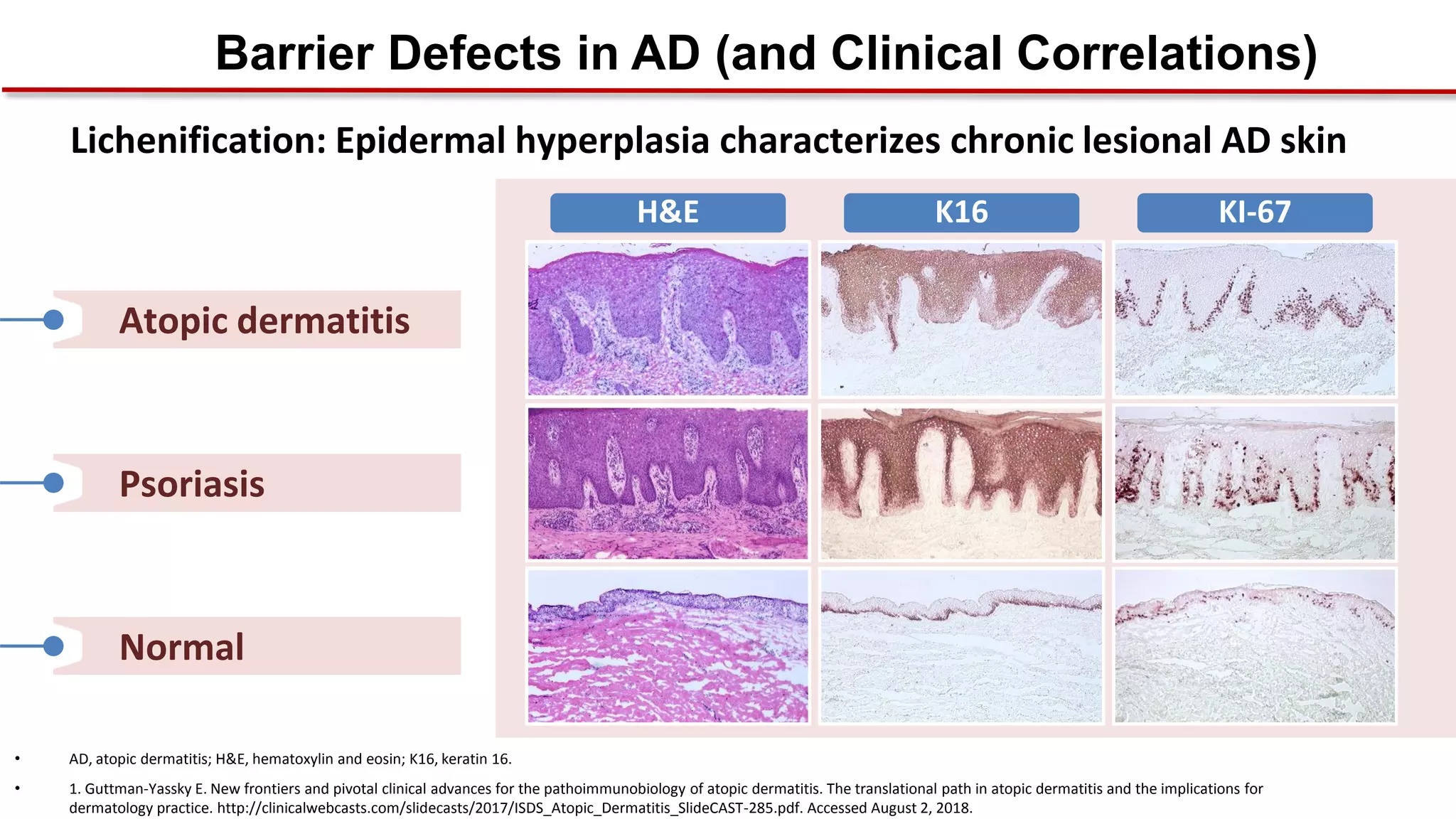 The atopic dermatitis pathogenesis and implications for alopecia areata ...